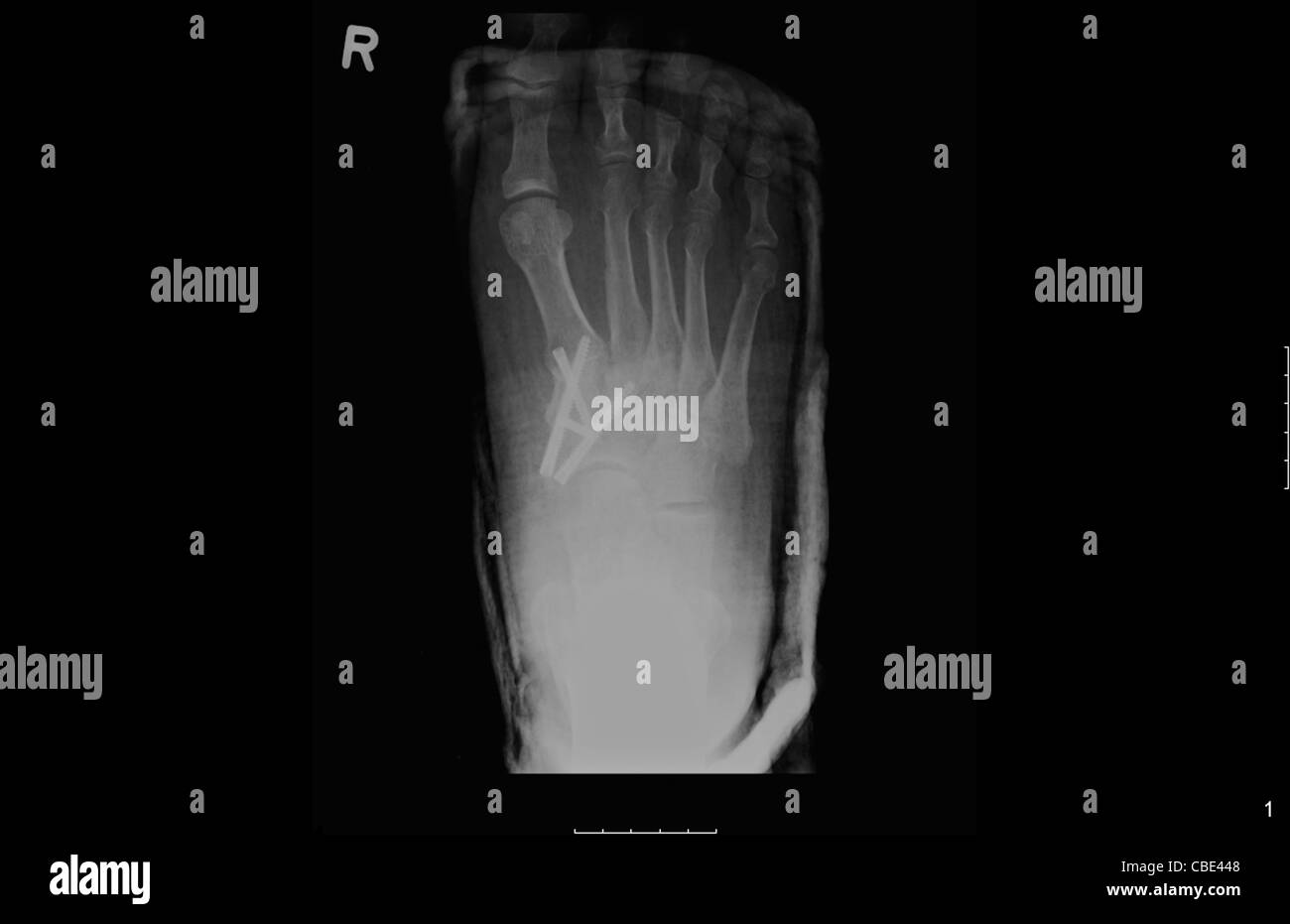 foot and ankle X-ray of a 47 year old male patient suffering from ...