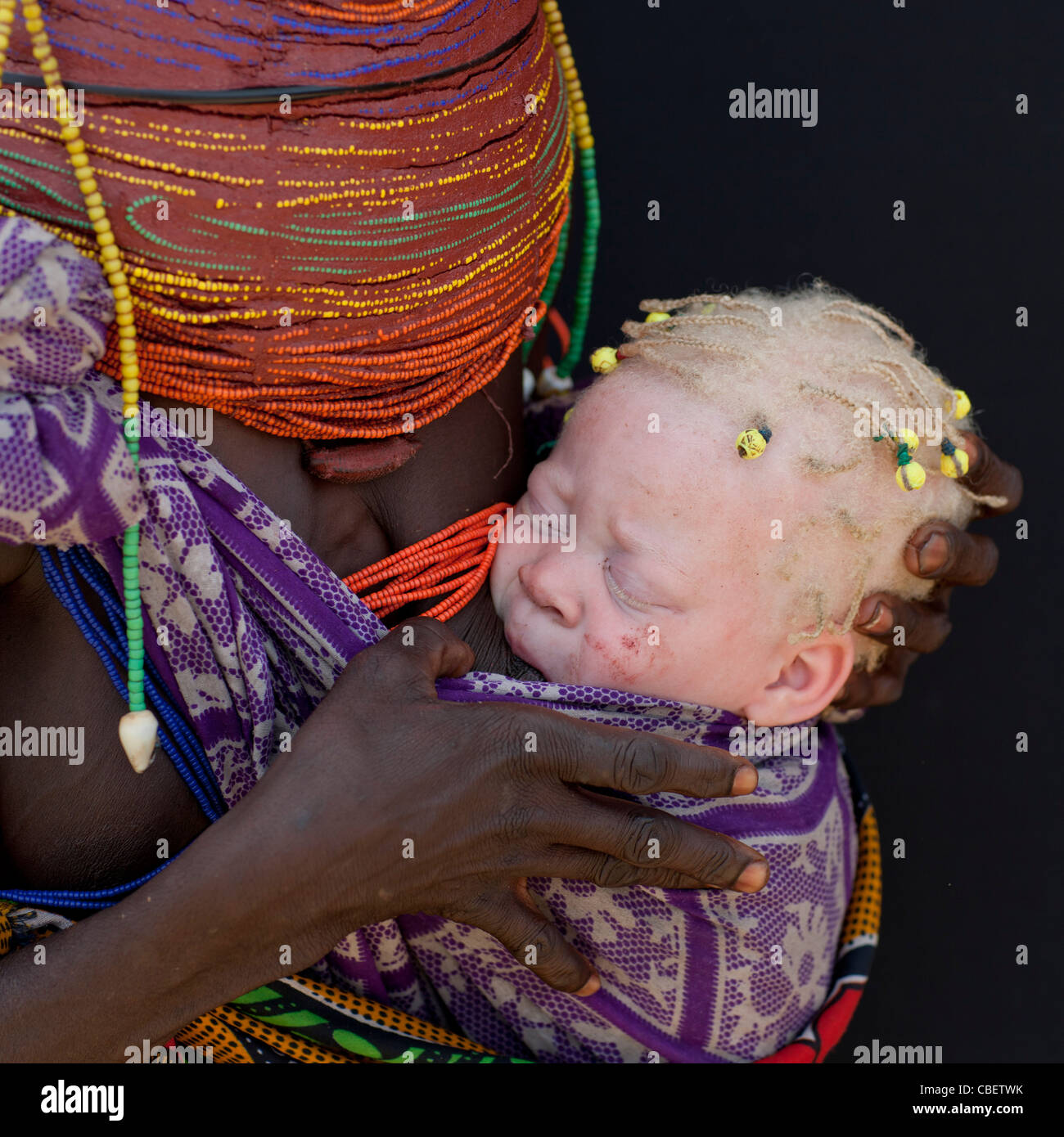 Black Albino Baby