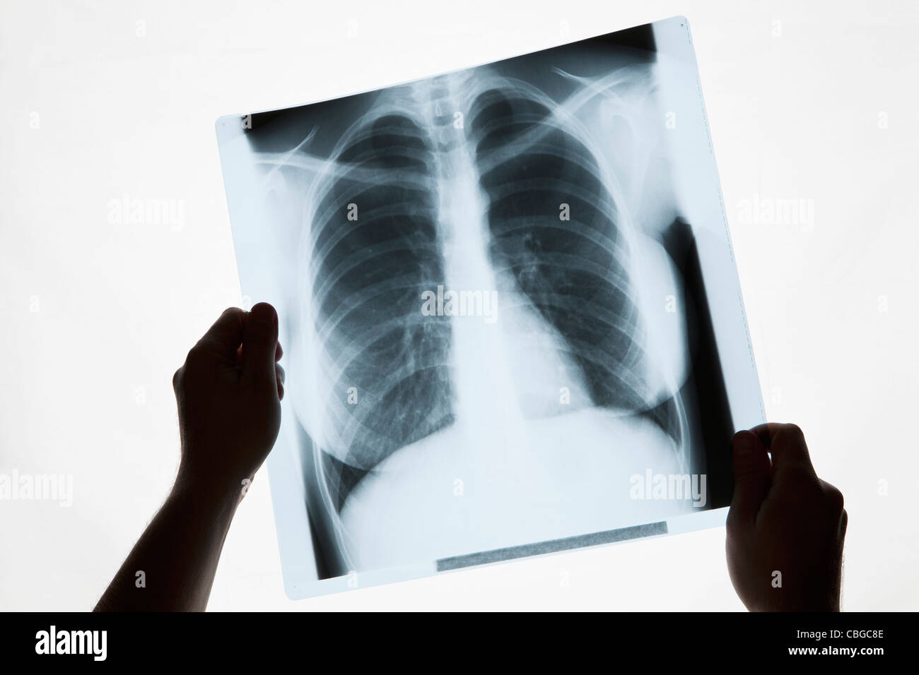 Chest x ray hi-res stock photography and images - Alamy