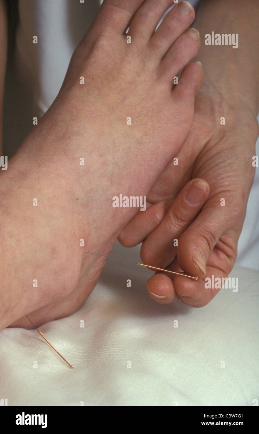 Feet woman acupuncture hi-res stock photography and images - Alamy