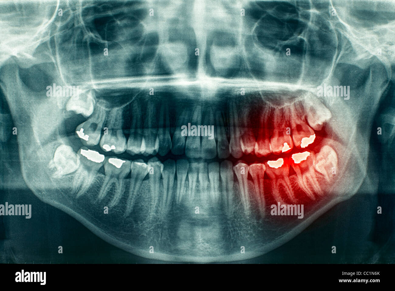 Teeth xray hi-res stock photography and images - Alamy