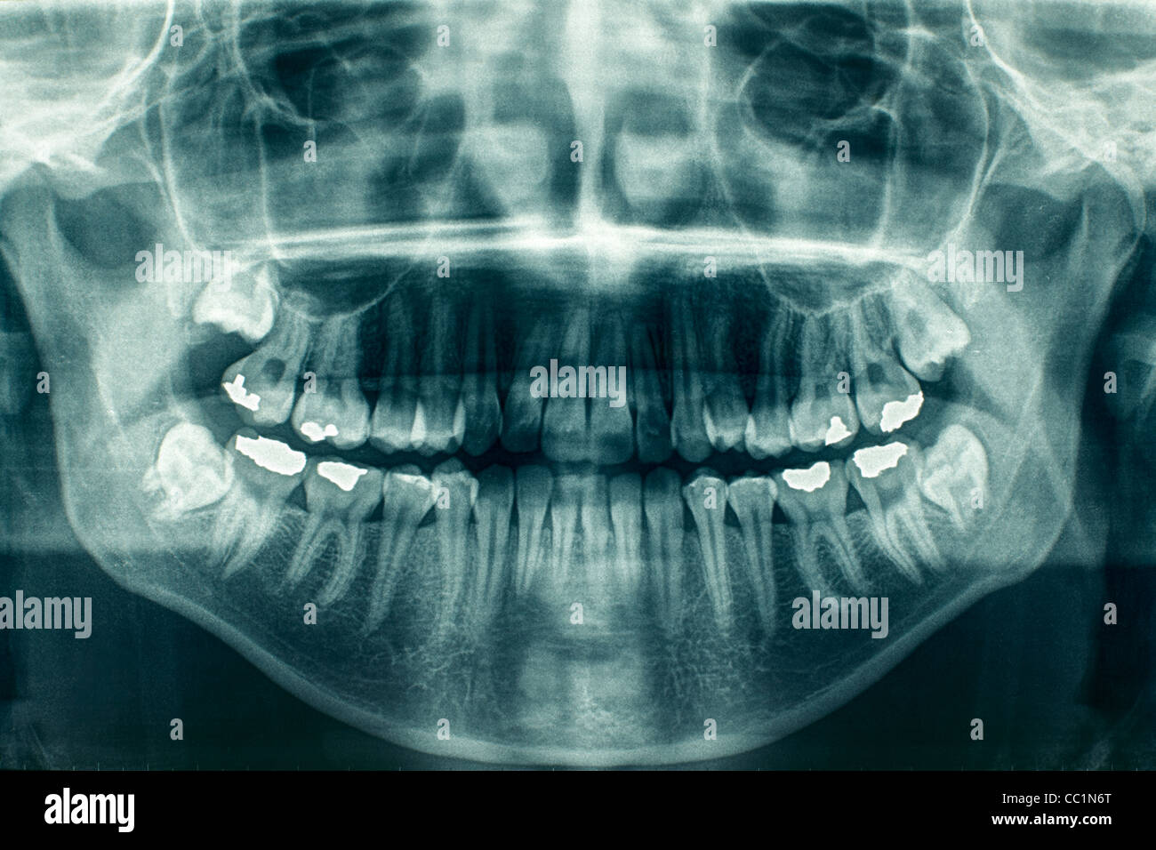 Panoramic dental ray teeth hi-res stock photography and images - Alamy