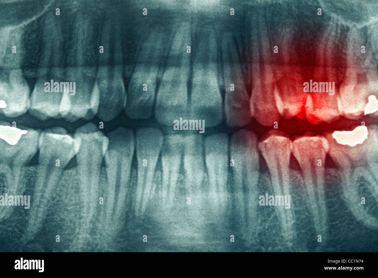 Teeth xray hi-res stock photography and images - Alamy