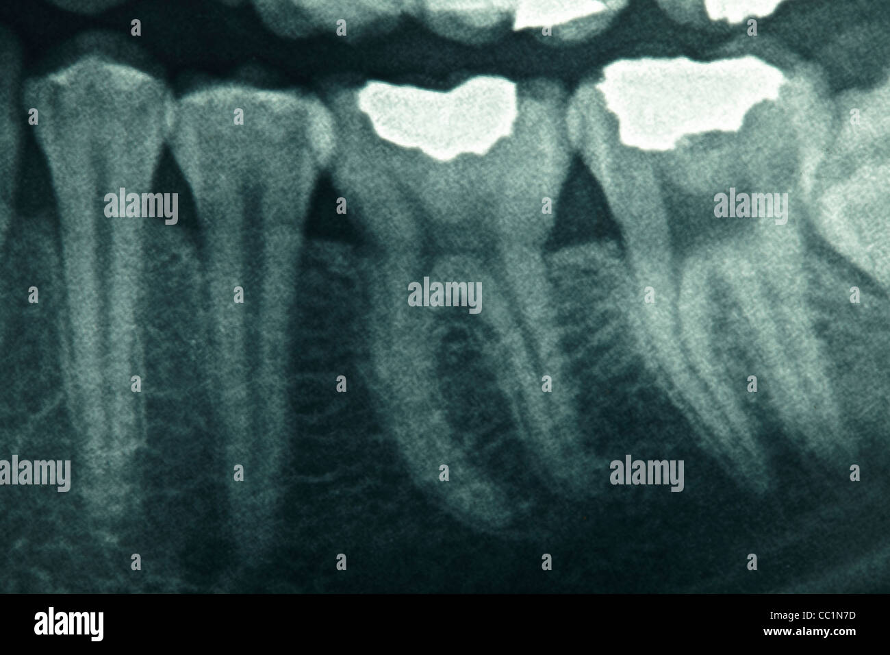 Human teeth xray hi-res stock photography and images - Alamy
