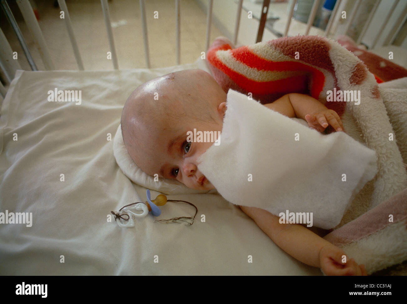 Hydrocephalus In Babies