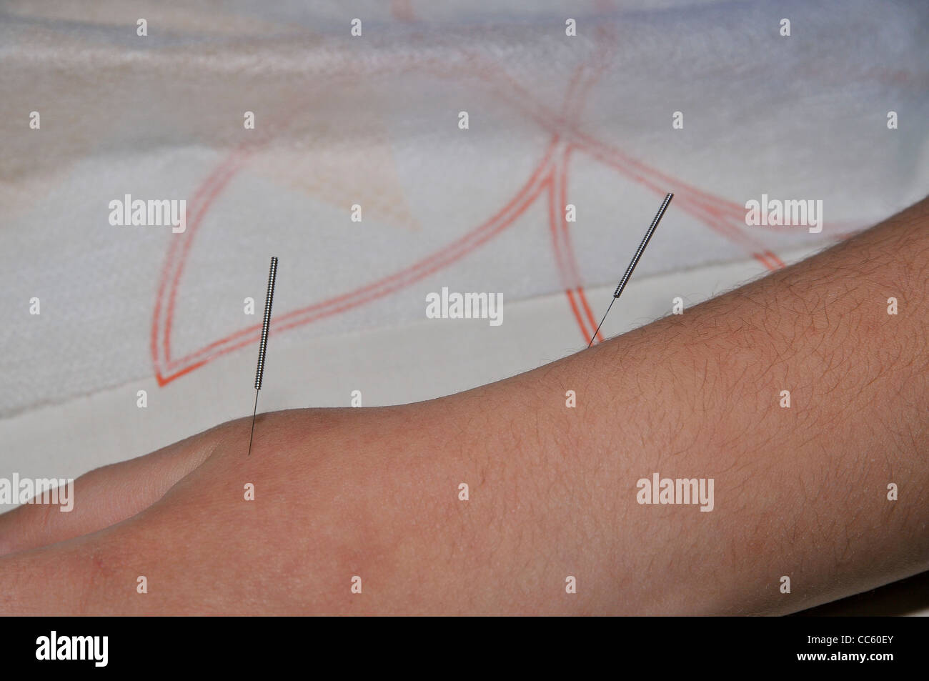 Chinese Acupuncture needle in a child's arm Stock Photo - Alamy