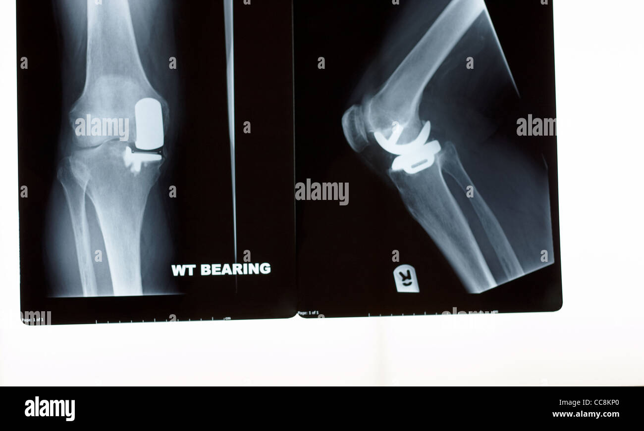 Knee replacement x ray hi-res stock photography and images - Alamy