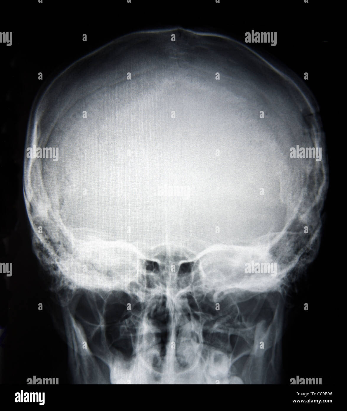 Skull Xray Stock Photos & Skull Xray Stock Images - Alamy