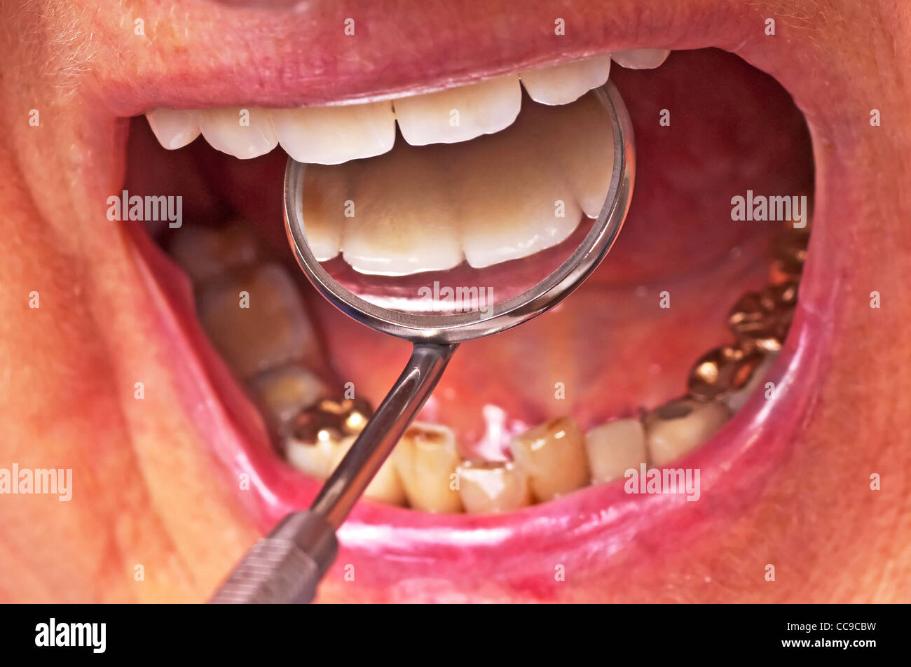 Upper front teeth hi-res stock photography and images - Alamy