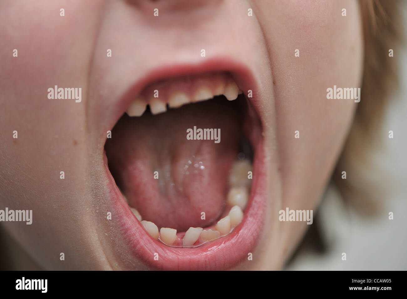 Wobbly tooth hi-res stock photography and images - Alamy