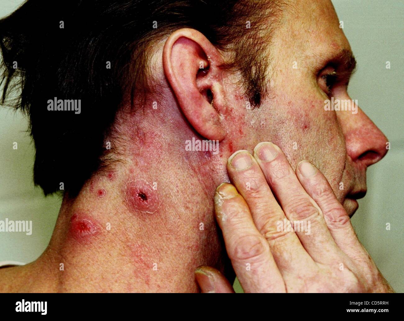 Boils On Neck