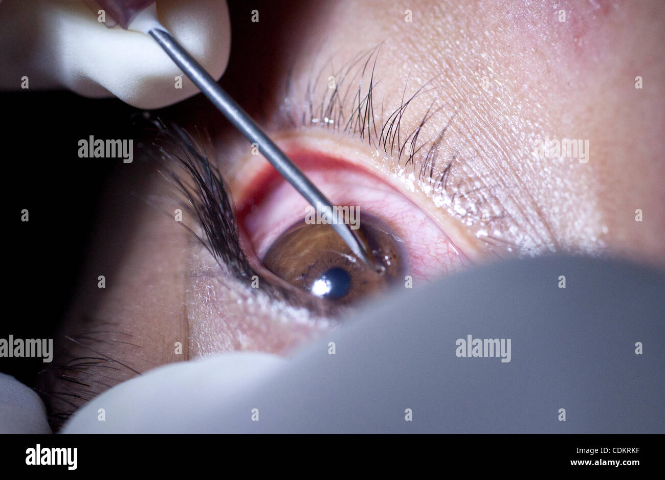 Cornea metal hi-res stock photography and images - Alamy