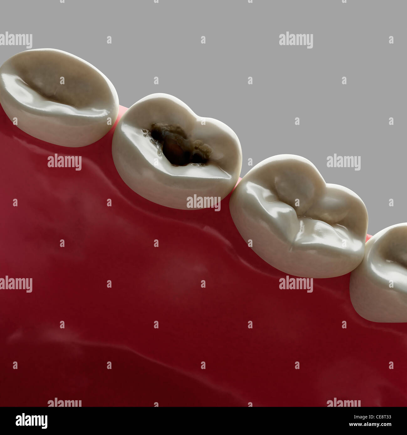 Tooth decay. Computer artwork of a tooth with cavities Stock Photo - Alamy