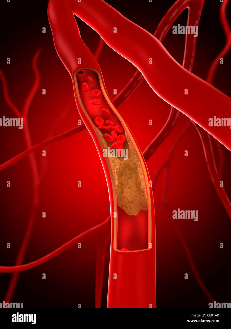 Narrowed artery. Computer artwork of an artery that is partially ...