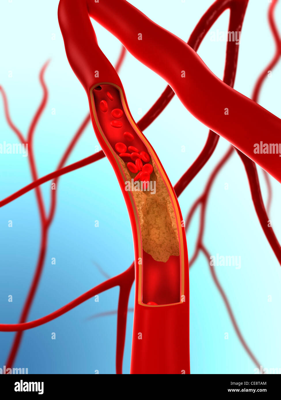 Narrowed artery. Computer artwork of an artery that is partially ...
