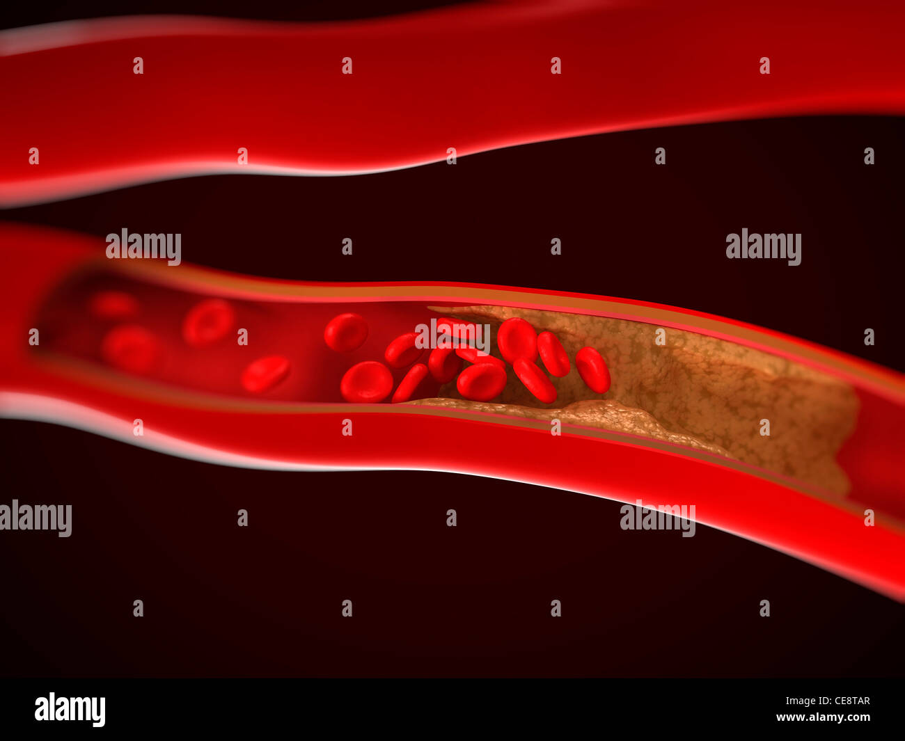 Narrowed artery. Computer artwork of an artery that is partially ...