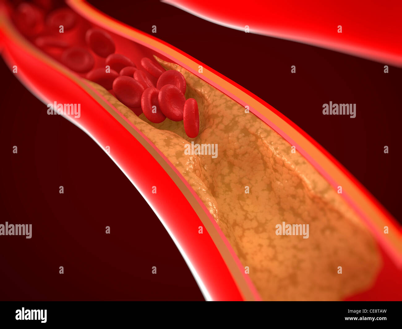 Narrowed artery. Computer artwork of an artery that is partially ...