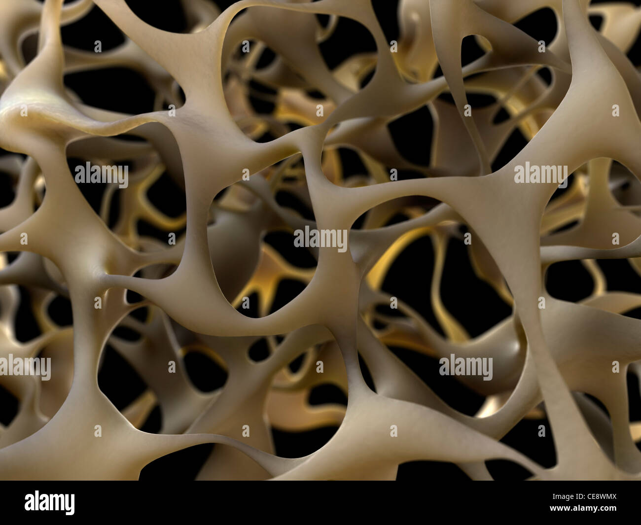 Osteoporotic bone, computer artwork Stock Photo - Alamy