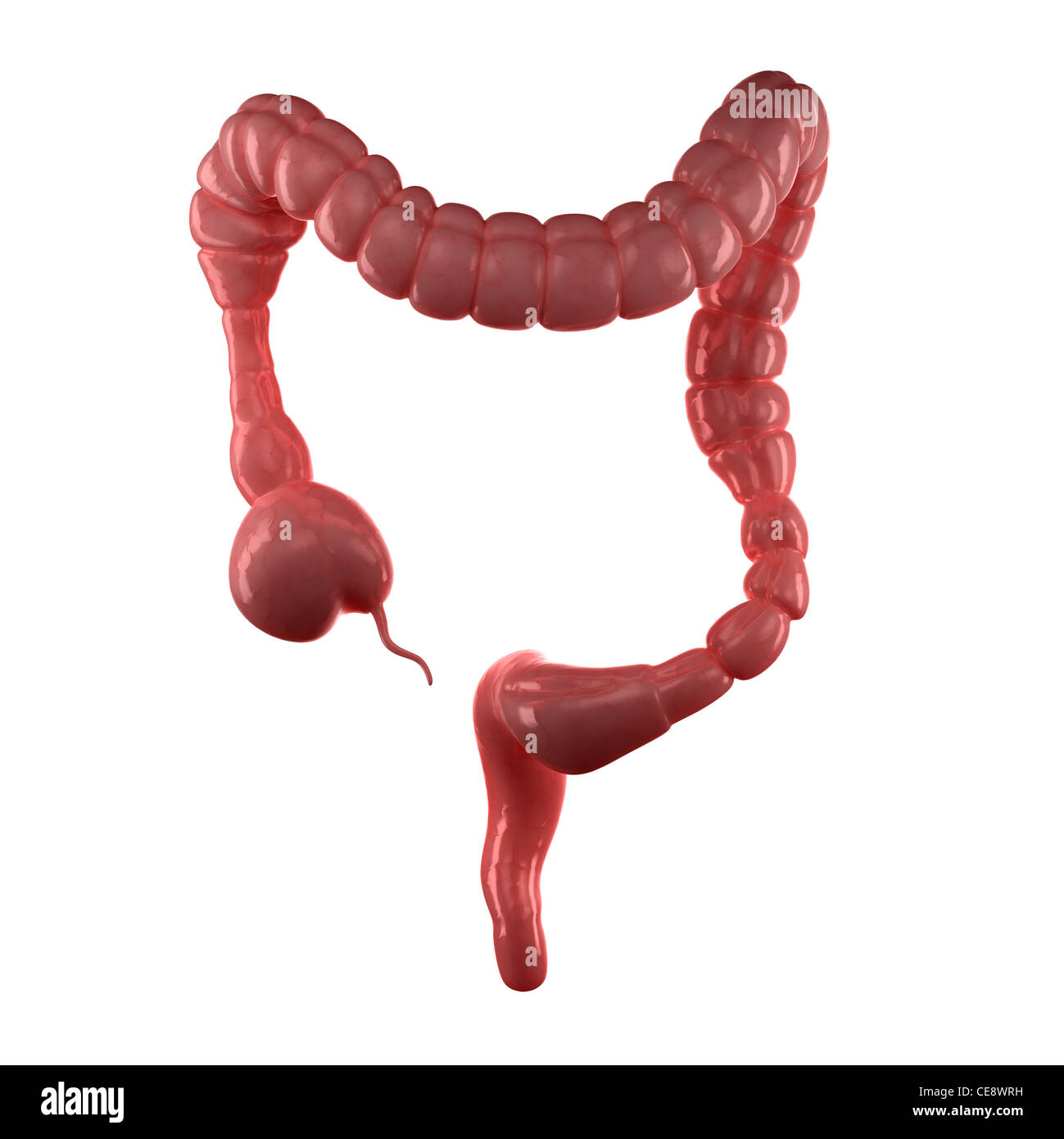 Colonic spasm, computer artwork. The spasms are the narrowed areas at ...
