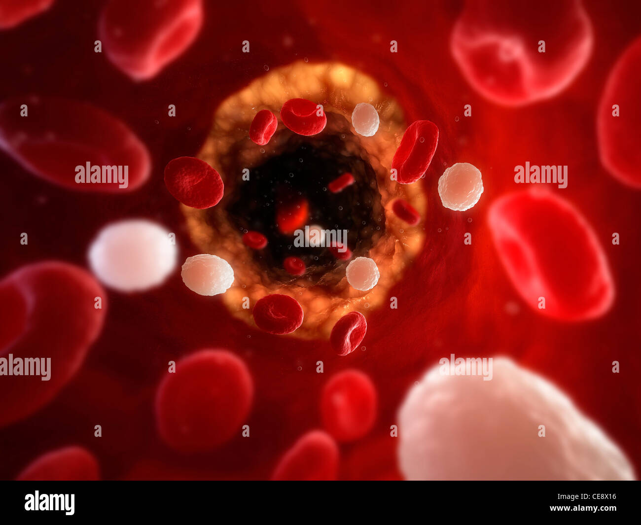 Narrowed artery. Computer artwork of an artery that is partially ...