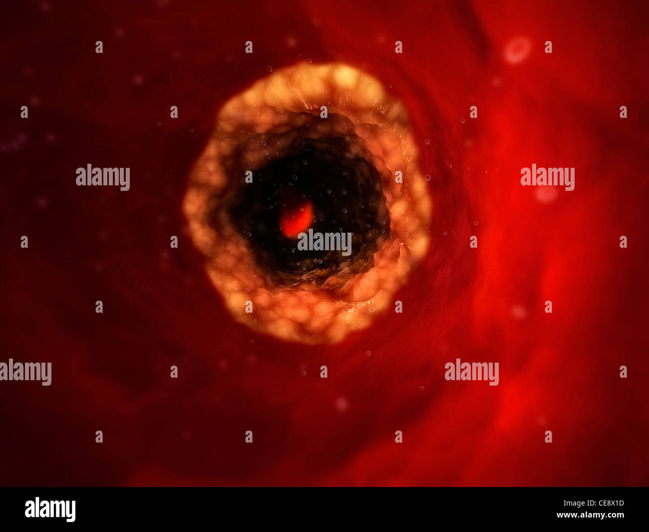 Narrowed artery. Computer artwork of an artery that is partially ...