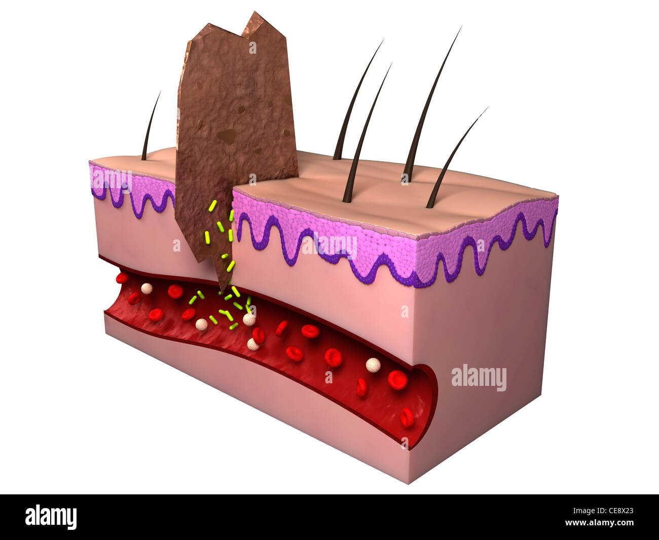 Wound infection. Computer artwork of bacteria (green) infecting a wound ...