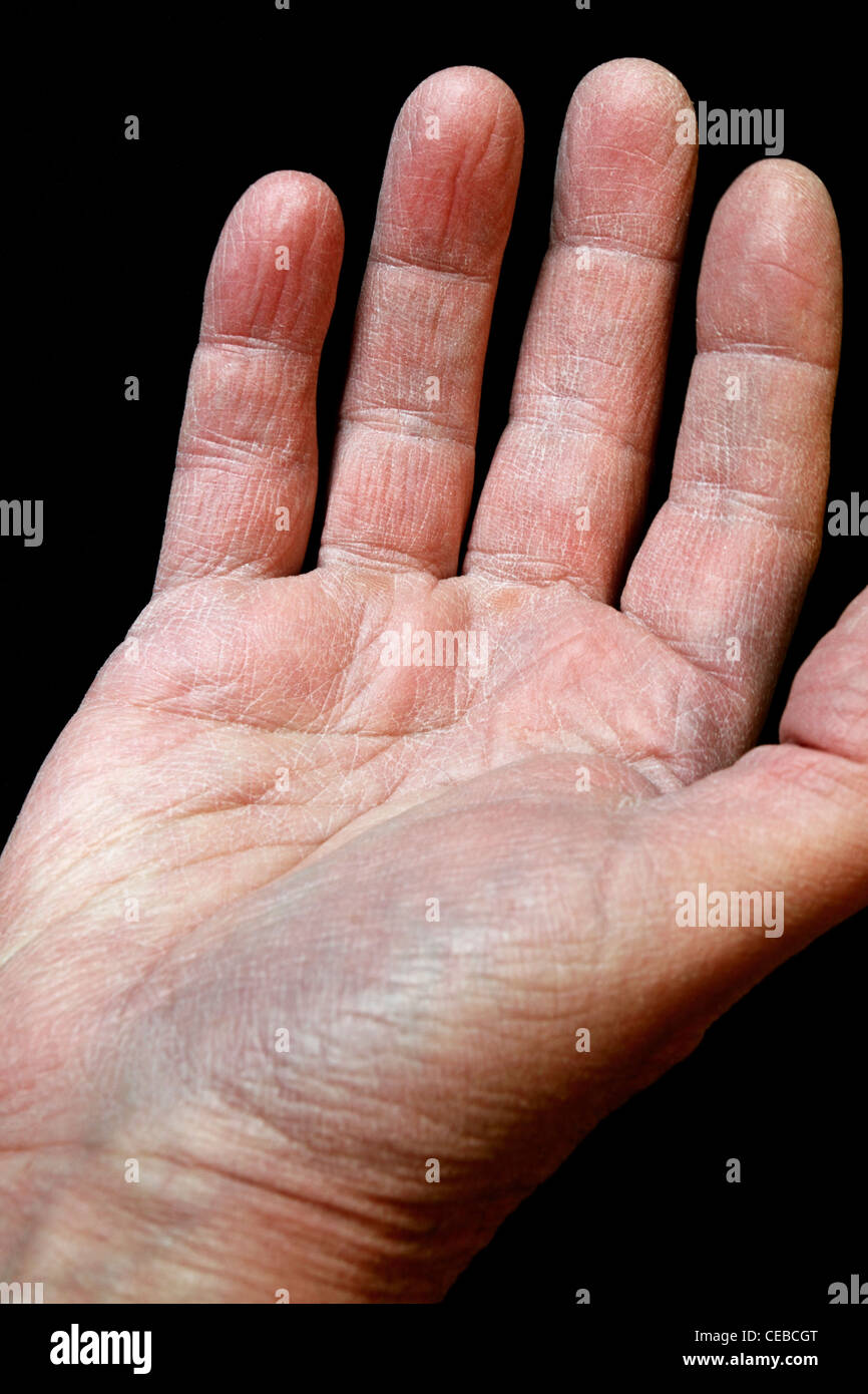 The dried cracked hand of an older man Stock Photo - Alamy