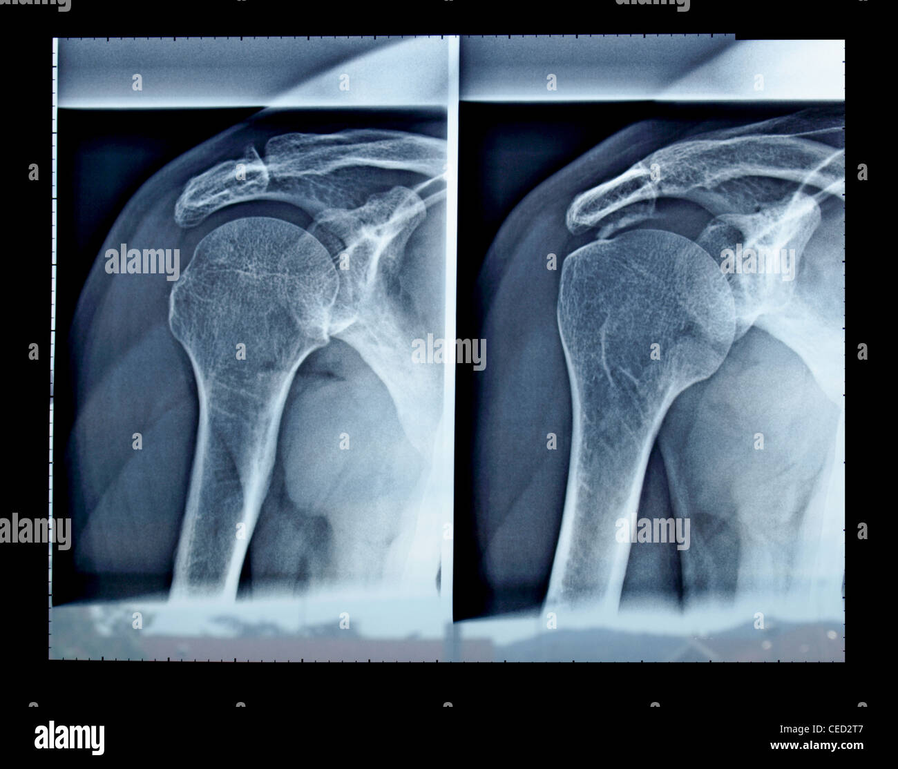 Medical X-Ray imaging of a shoulder, used in diagnostic radiology of ...