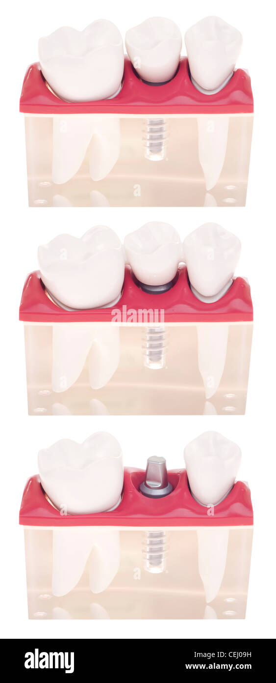 Implant dental model Stock Photo - Alamy
