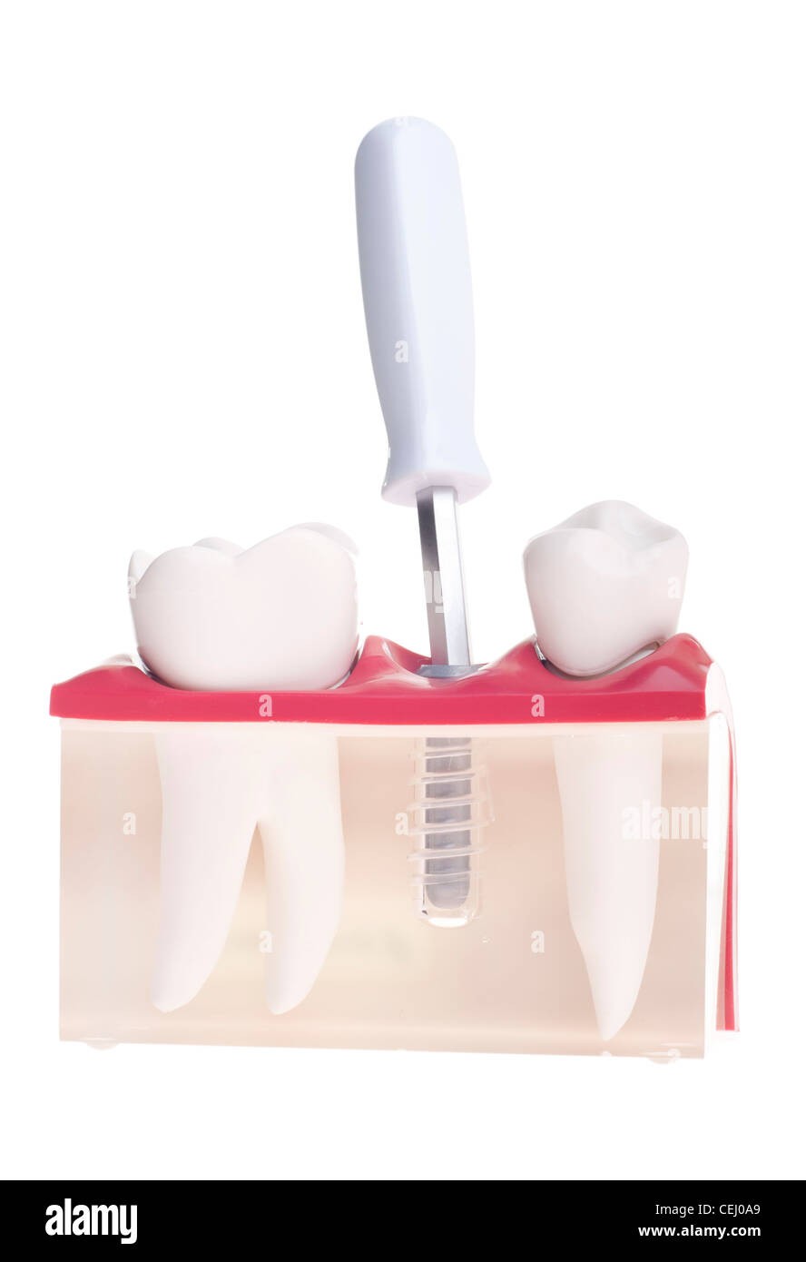 Implant dental model Stock Photo - Alamy
