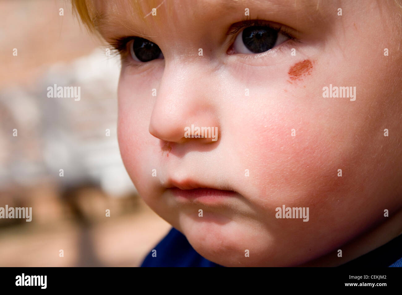 Male child with graze under eye Stock Photo - Alamy