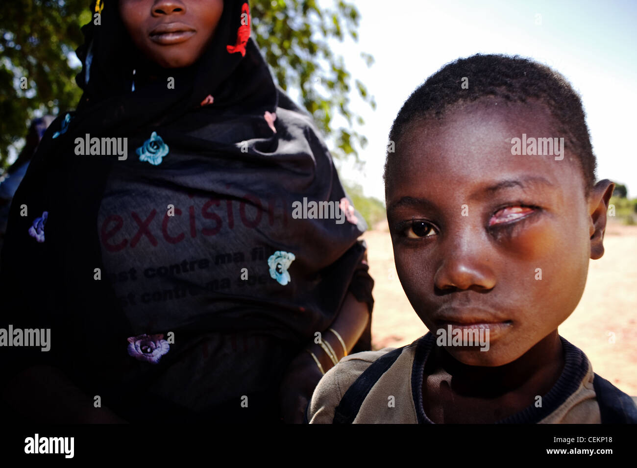 African child with injured eye in Niamey, Niger Stock Photo - Alamy