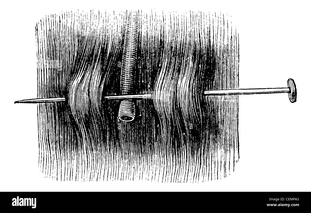 Acupressure with a single needle, vintage engraved illustration ...