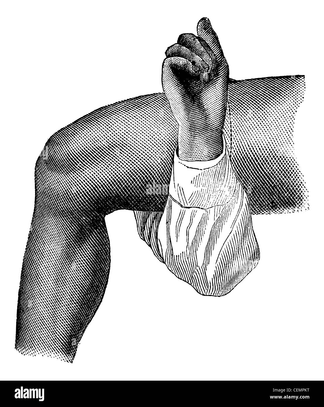 Amputation of the thigh by the circular method (skin incision), vintage ...