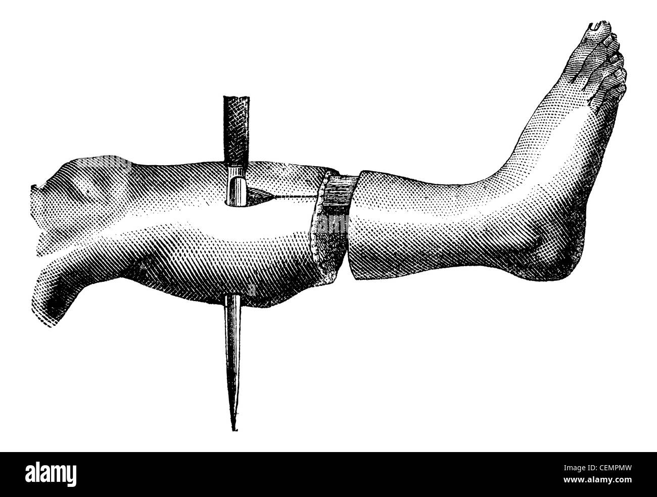 Amputation of the leg by the method has two flaps (formation of the ...