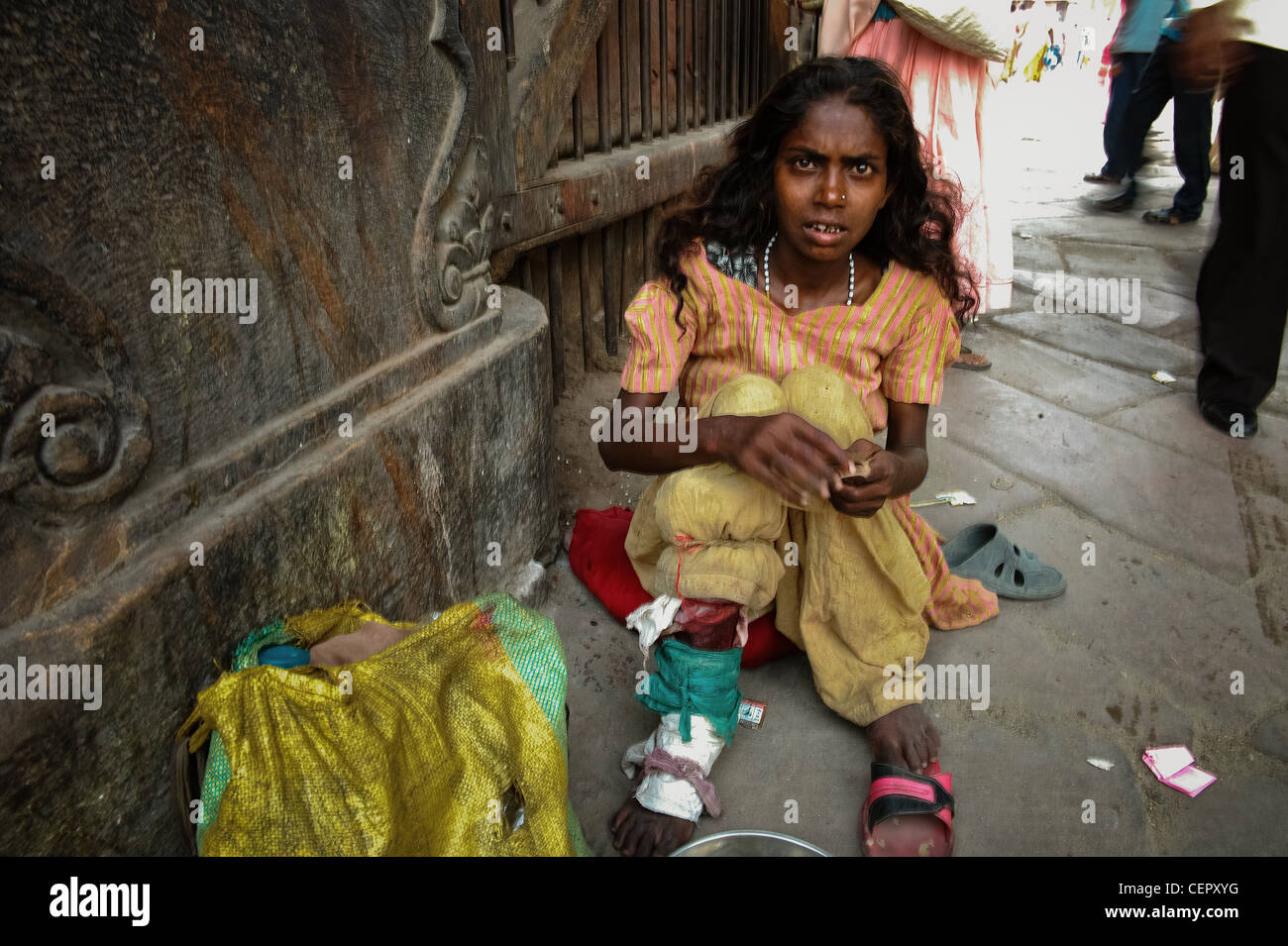 Indian glance, Girl of the street, gangrenous leg Stock Photo - Alamy