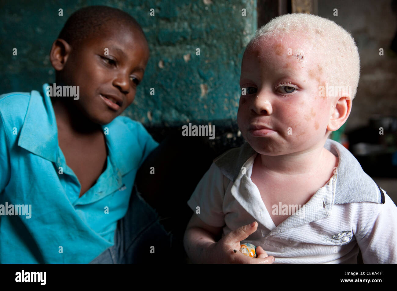 Albinism children hi-res stock photography and images - Alamy