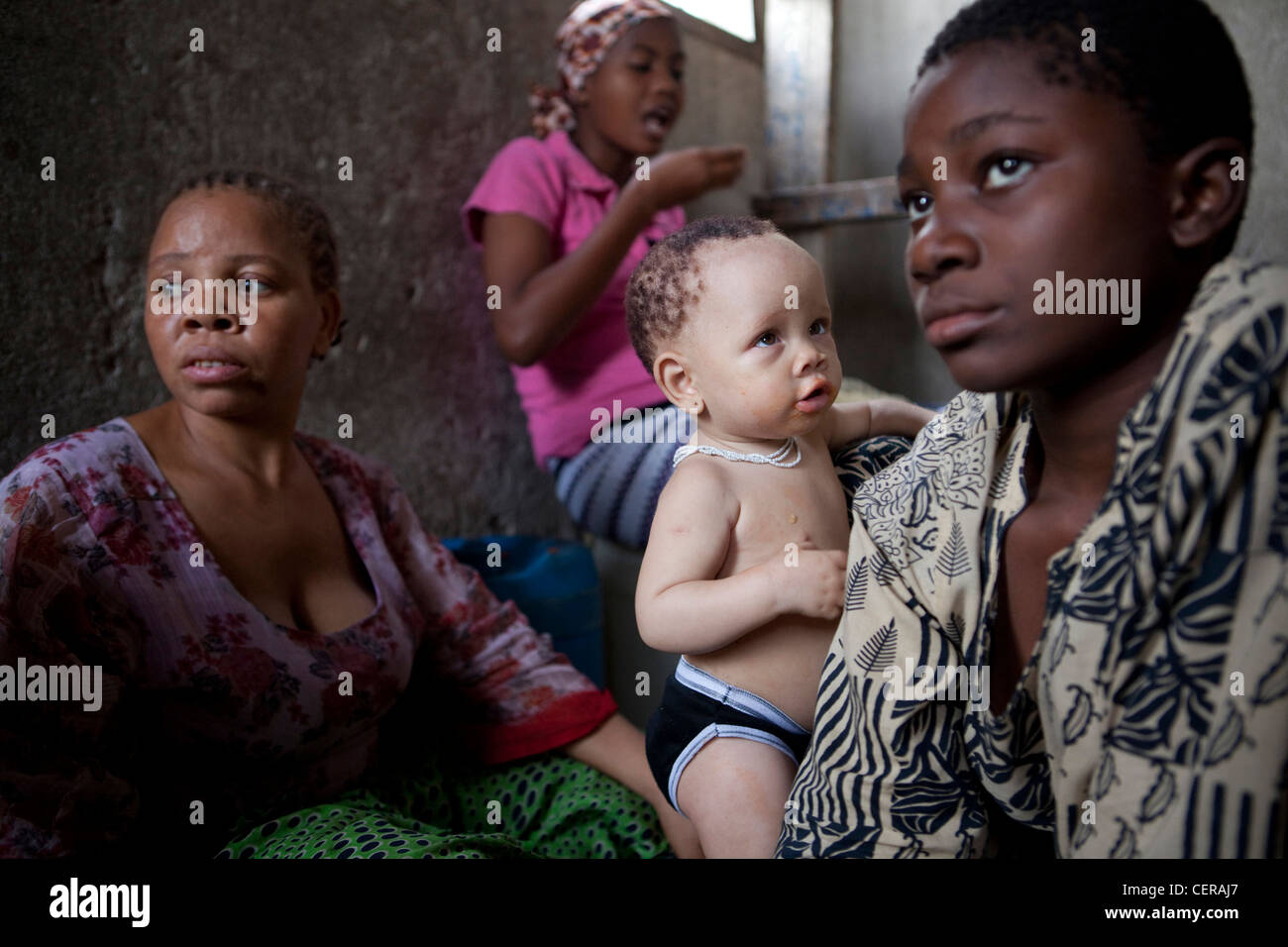 Albinism hi-res stock photography and images - Alamy