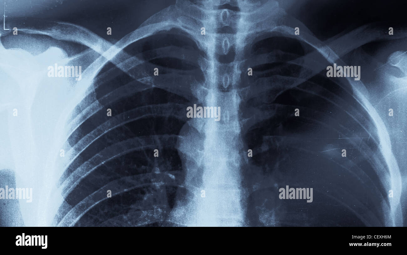 x-ray of chest of human Stock Photo - Alamy
