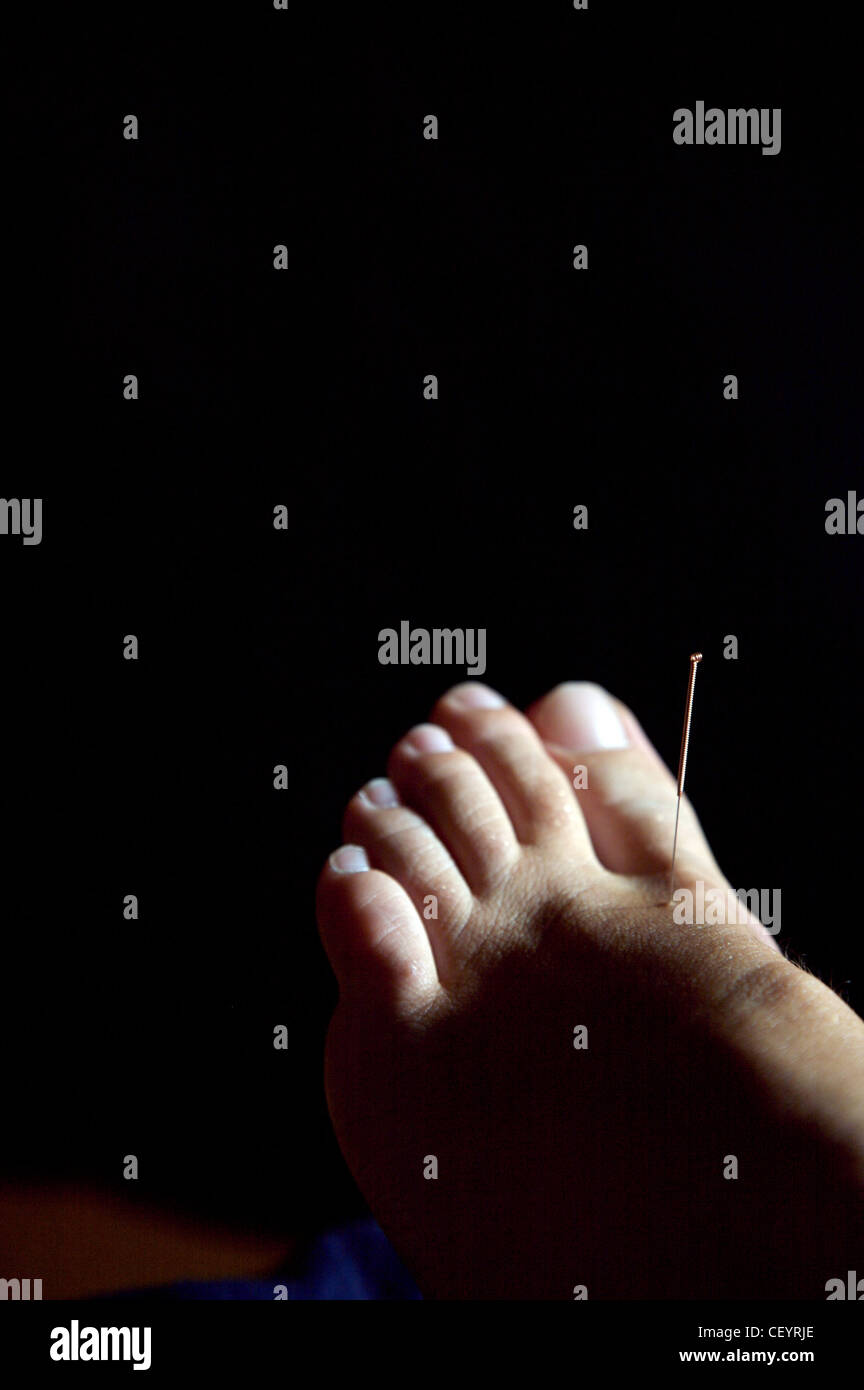 Acupuncture Female foot with acupuncture needle inserted into pressure ...