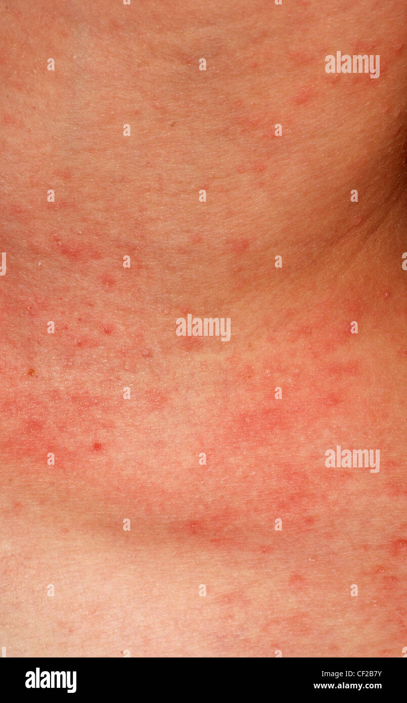 allergic rash dermatitis skin texture of patient Stock Photo - Alamy
