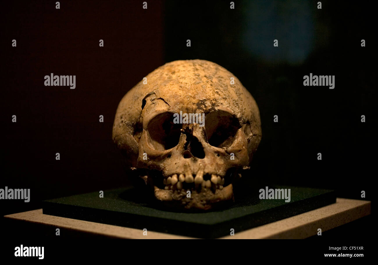 A child deformed skull is displayed in the National Museum of ...