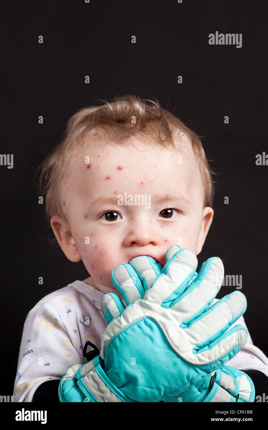 little boy with chickenpox Stock Photo - Alamy