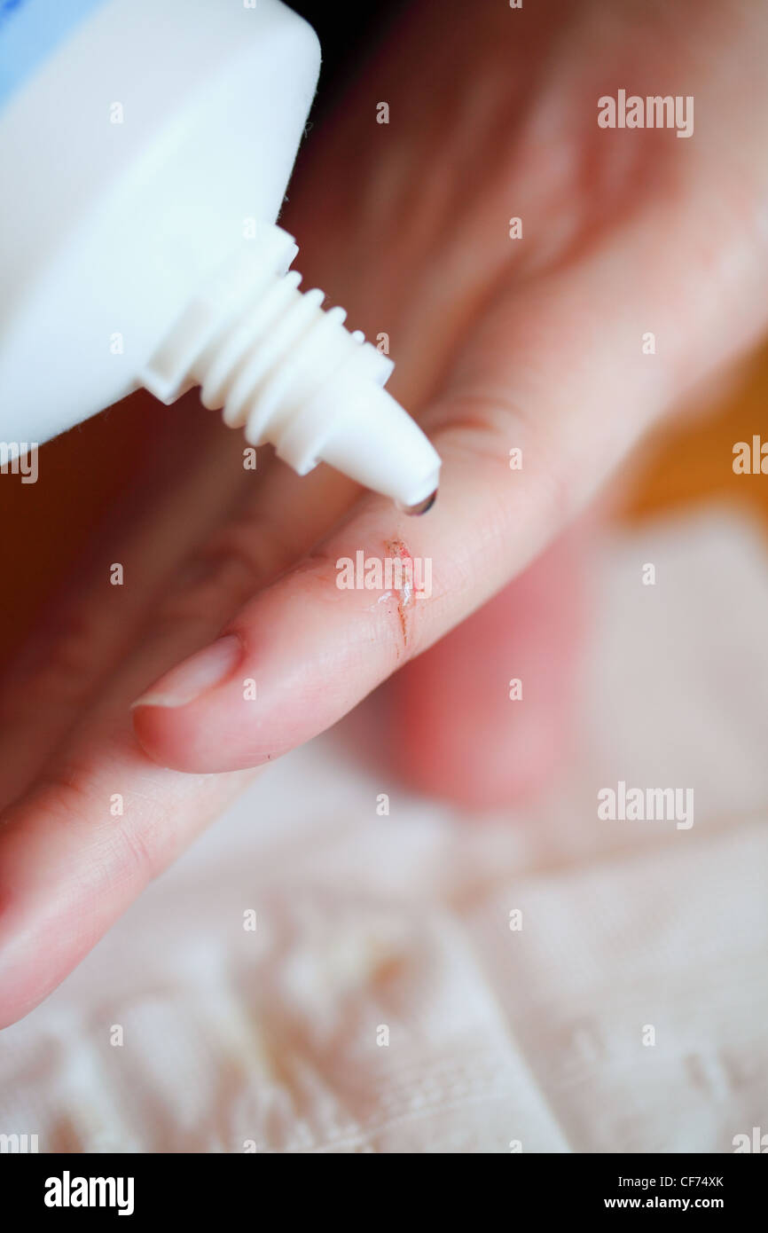 disinfect the scratch by rubbing in alcohol cuts on the hand Stock ...