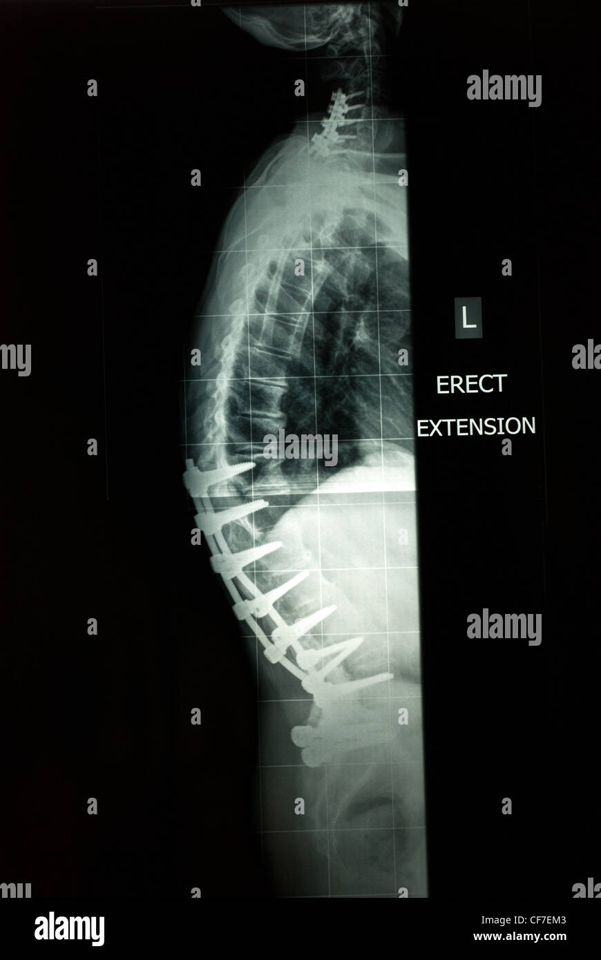 Broken neck x ray hi-res stock photography and images - Alamy