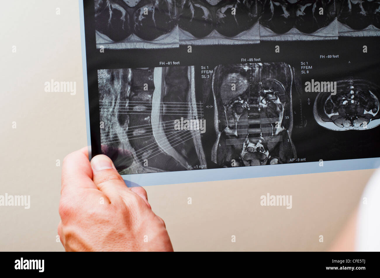 Spinal radiograph hi-res stock photography and images - Alamy