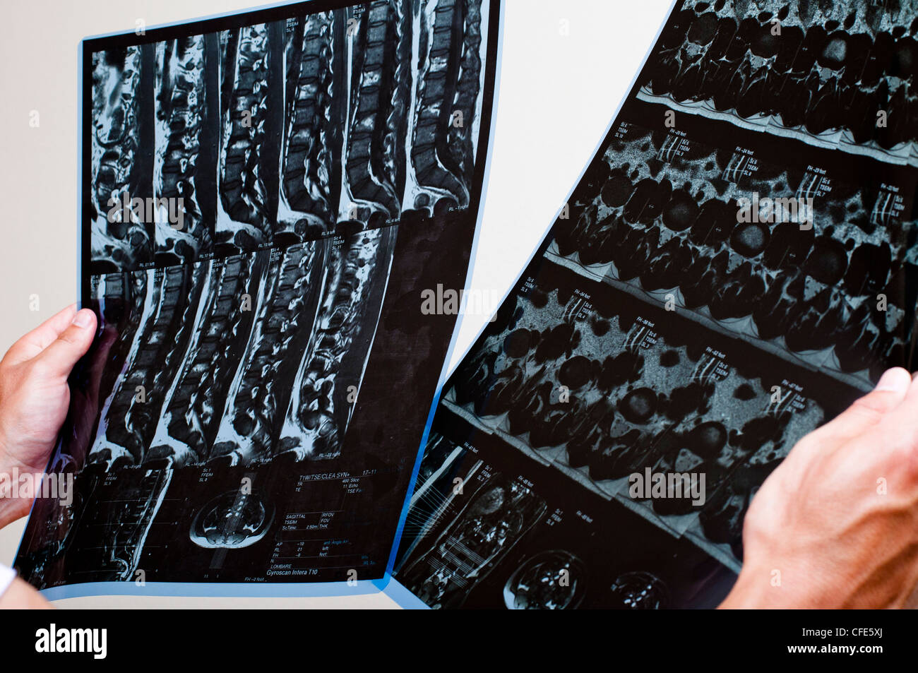 MRI of a patient with spinal pathology Stock Photo - Alamy