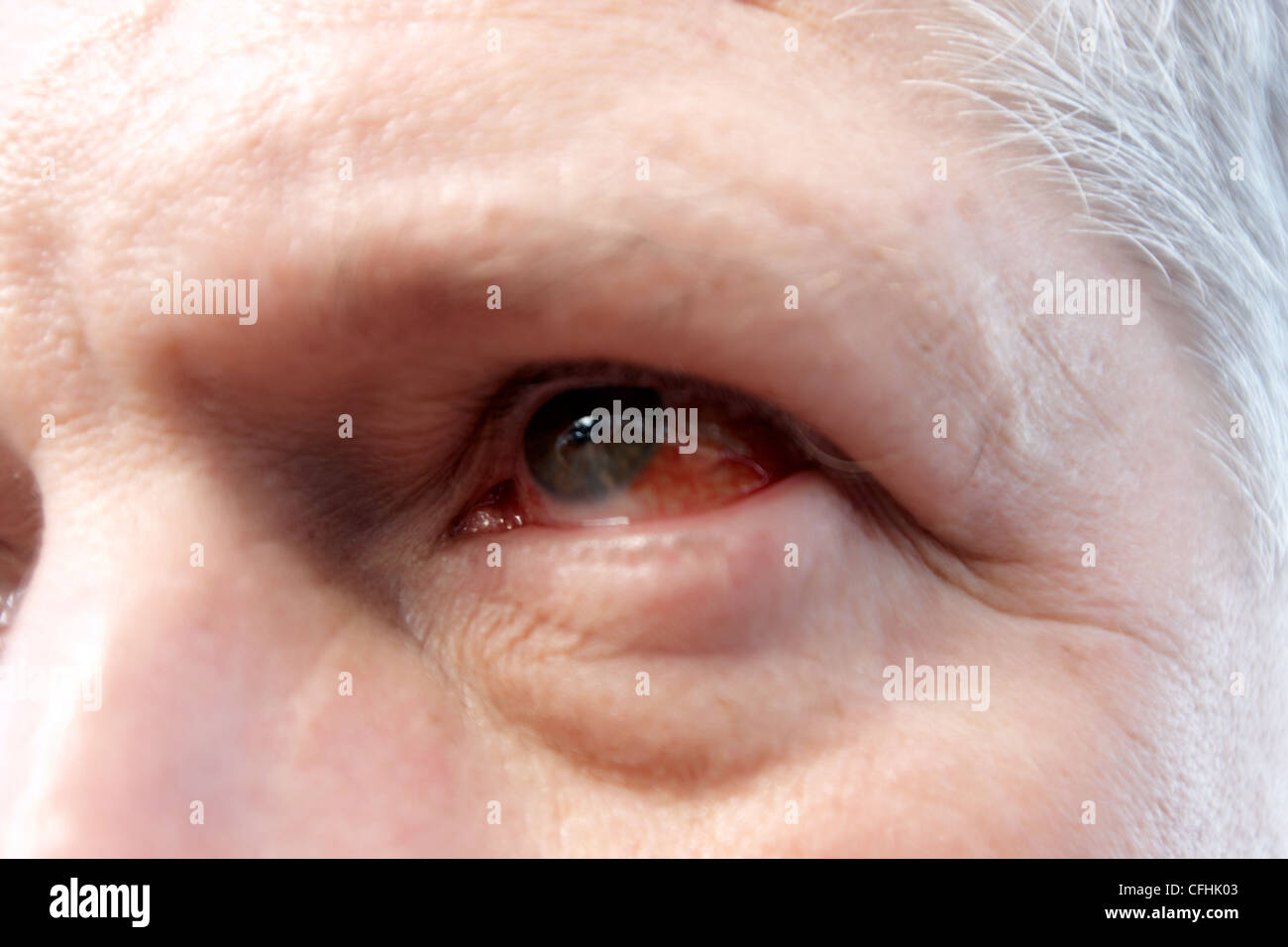 A mature man with conjunctivitis a blood shot eye Stock Photo - Alamy