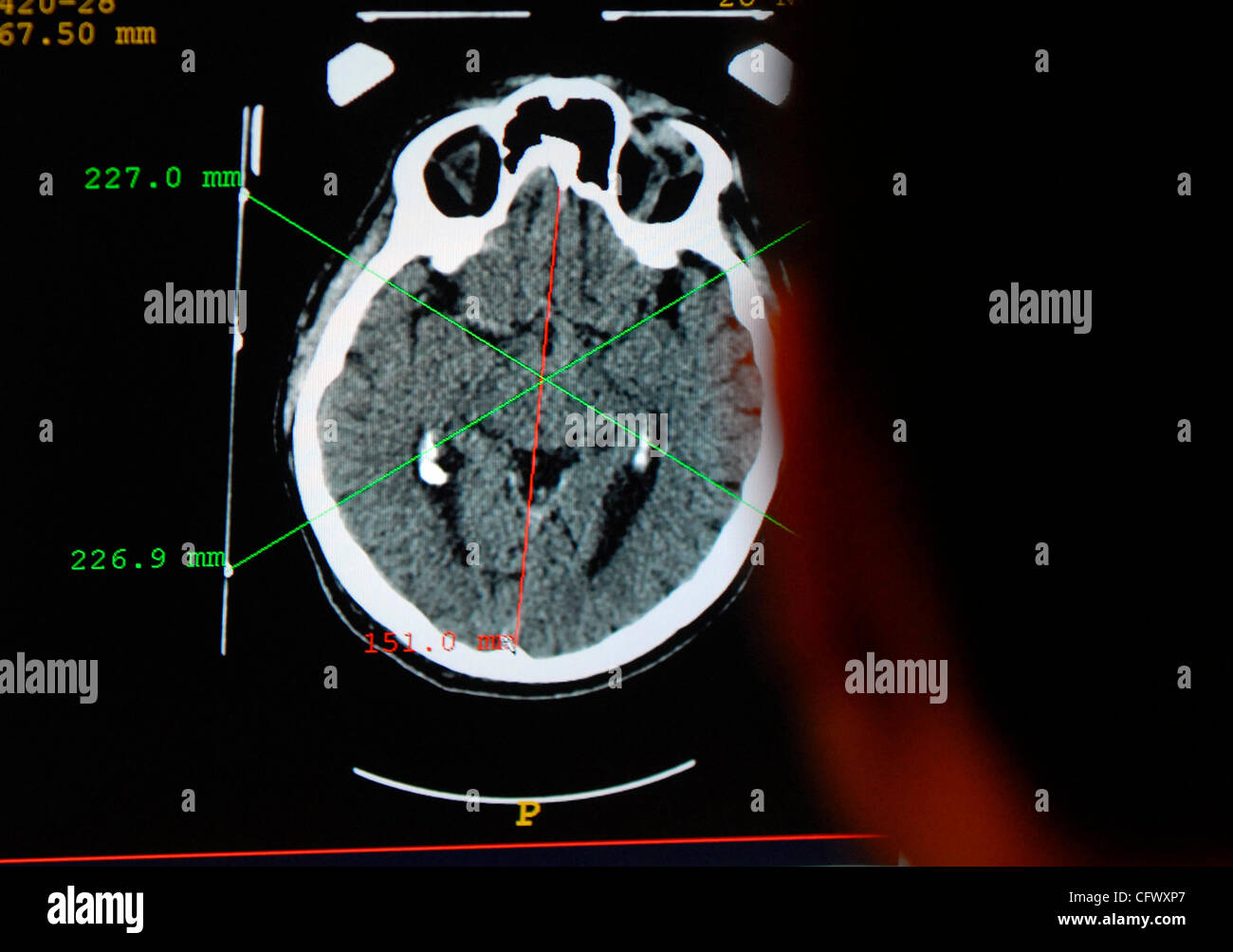Subthalamic Nucleus Mri