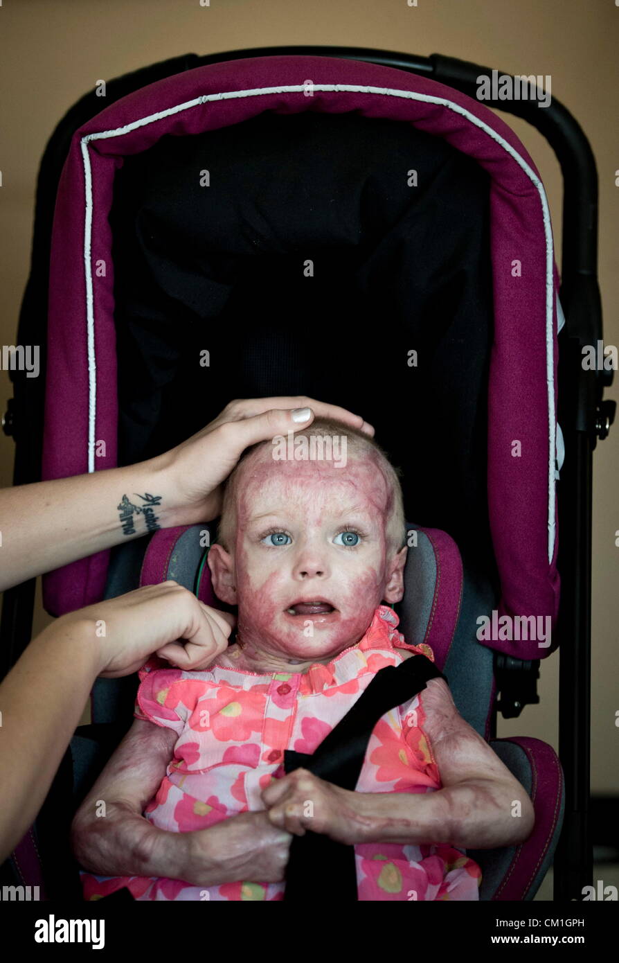 JOHANNESBURG, SOUTH AFRICA: 3-year-old burn survivor Isabella Pippie ...